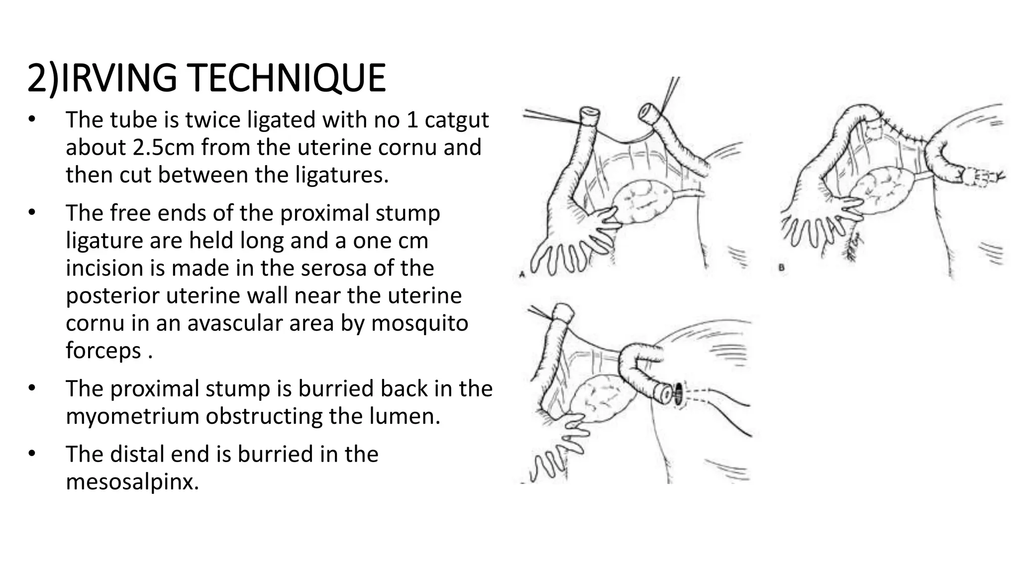 TUBECTOMY PPT by Dr Bandari Sajala, Ms OBGYN | PPTX