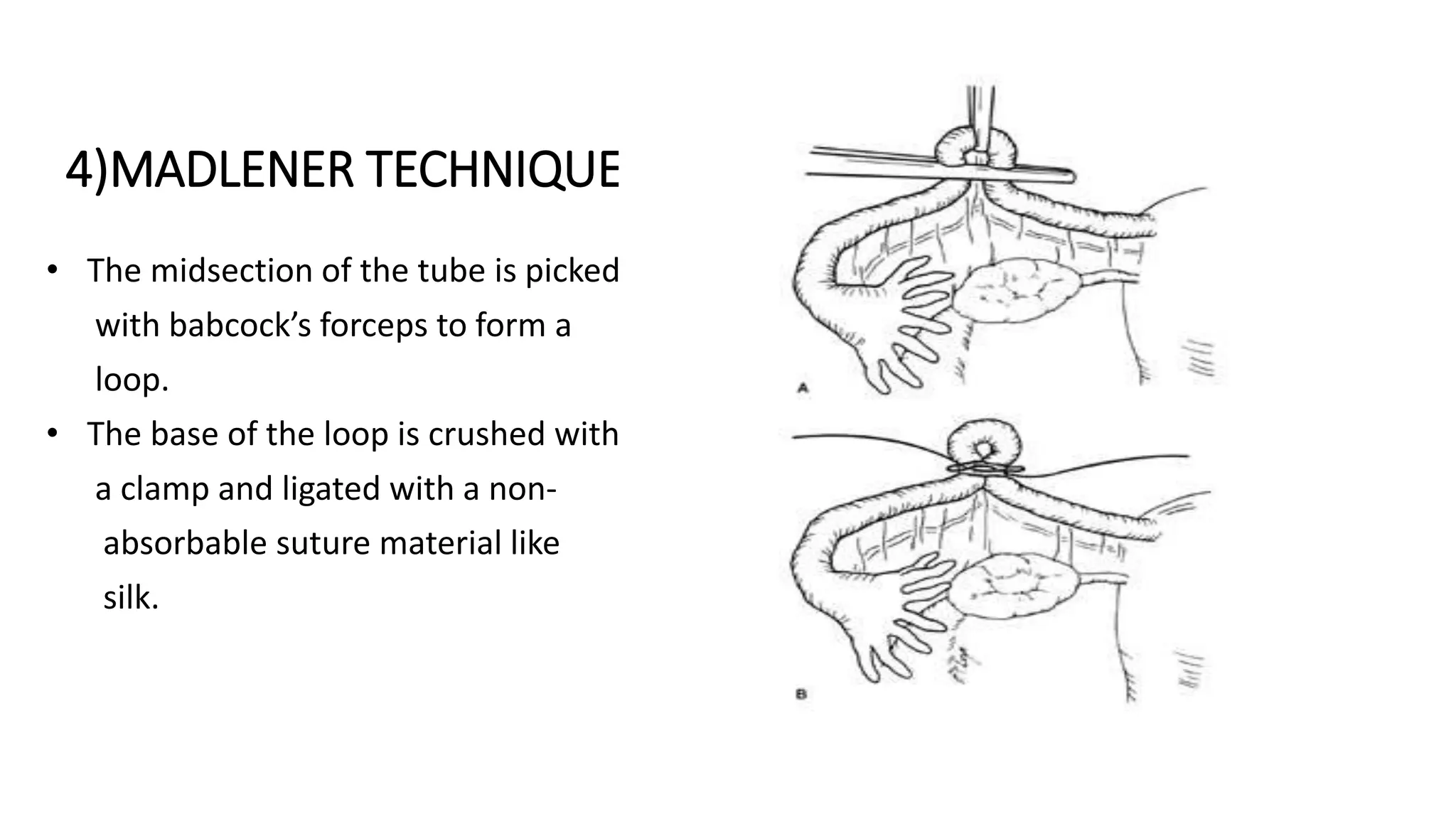 TUBECTOMY PPT by Dr Bandari Sajala, Ms OBGYN | PPTX