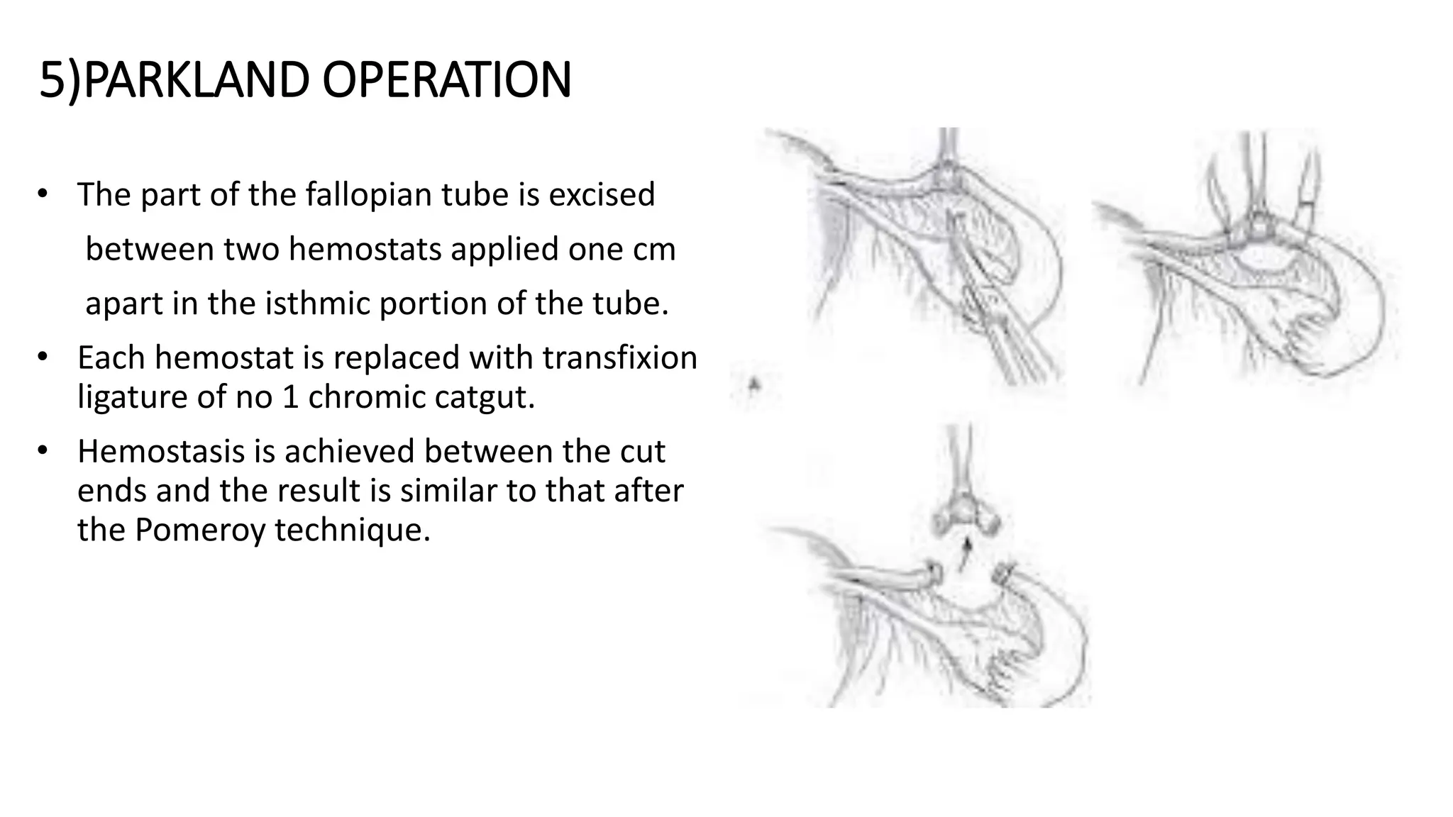 TUBECTOMY PPT by Dr Bandari Sajala, Ms OBGYN | PPTX