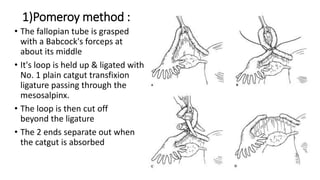 TUBECTOMY PPT by Dr Bandari Sajala, Ms OBGYN | PPTX
