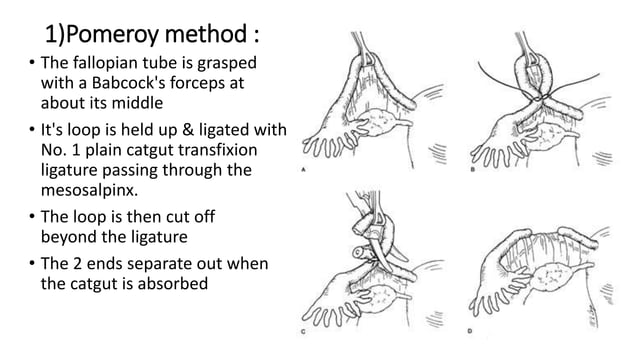 TUBECTOMY PPT by Dr Bandari Sajala, Ms OBGYN | PPTX | Infertility ...