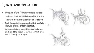 TUBECTOMY PPT by Dr Bandari Sajala, Ms OBGYN | PPTX
