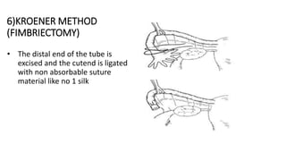 TUBECTOMY PPT by Dr Bandari Sajala, Ms OBGYN | PPTX