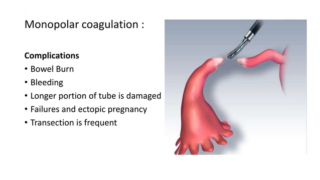 TUBECTOMY PPT by Dr Bandari Sajala, Ms OBGYN | PPTX | Infertility ...