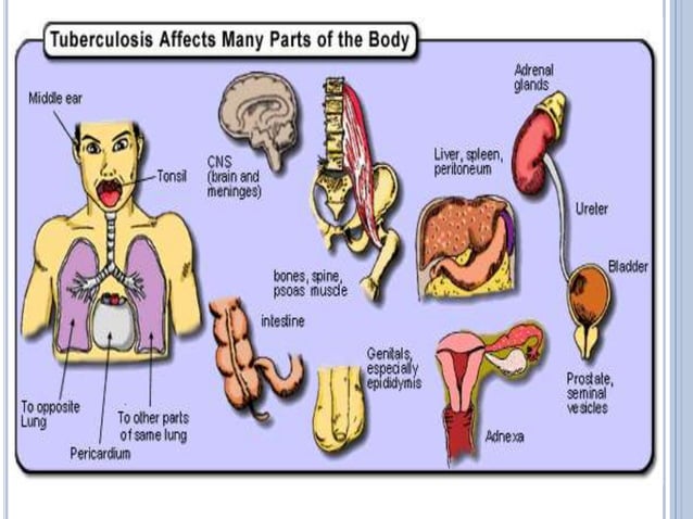 CLINICAL CLASSIFICATION OF TUBECULOSIS | PPTX | Lung and Respiratory ...