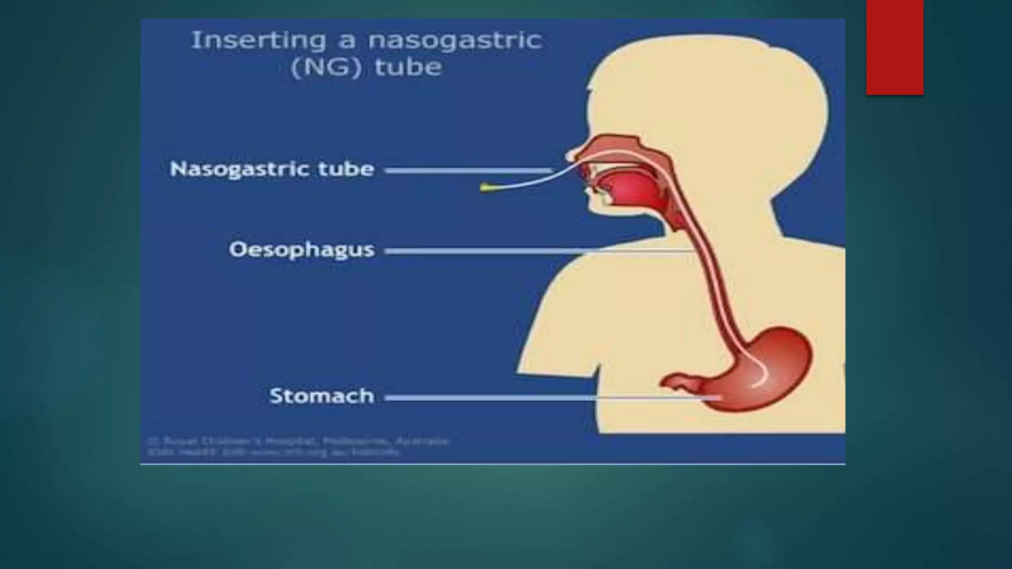 Tube feeding ( Gavage feeding ) | PPTX