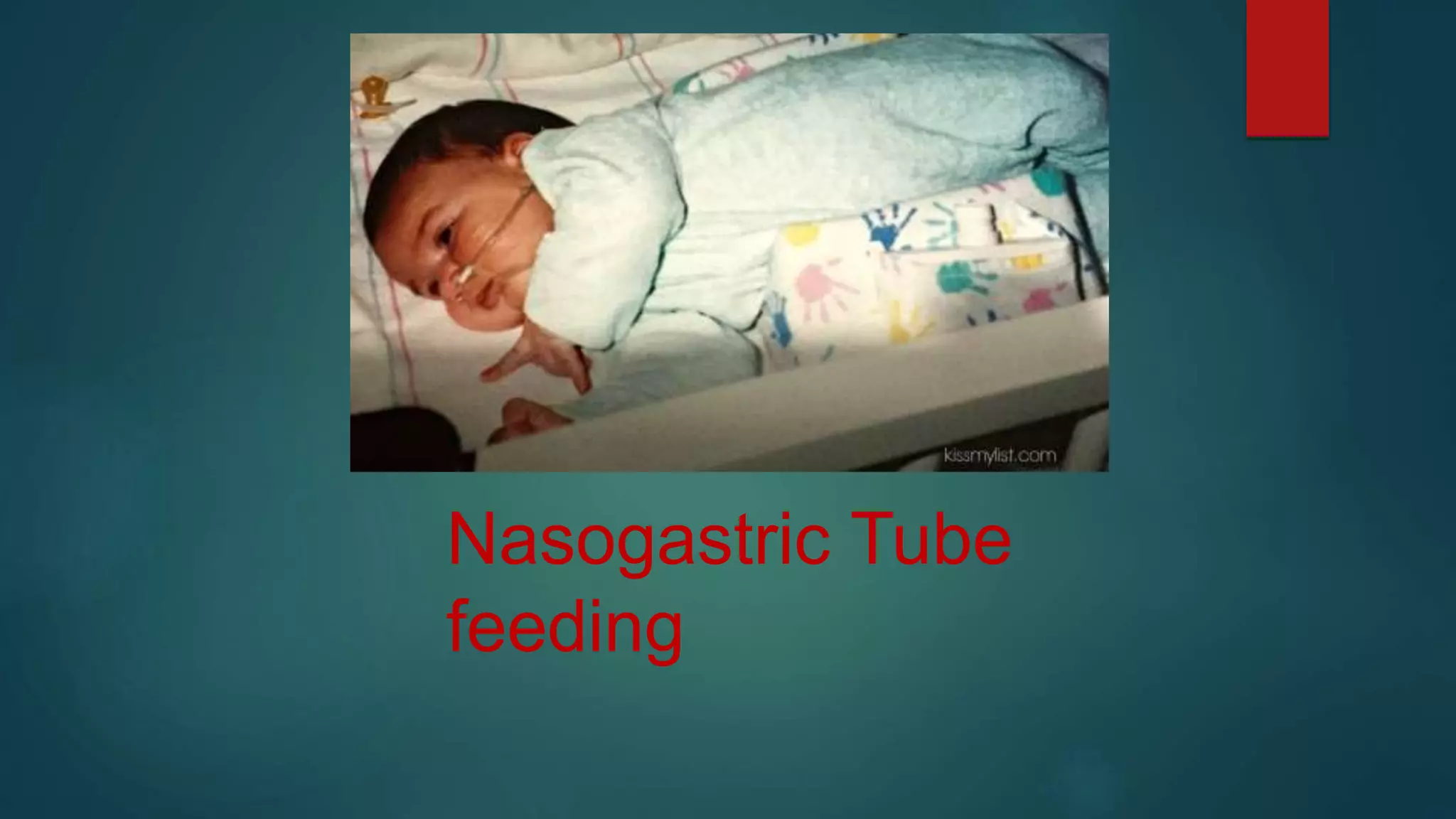 Tube feeding ( Gavage feeding ) | PPTX