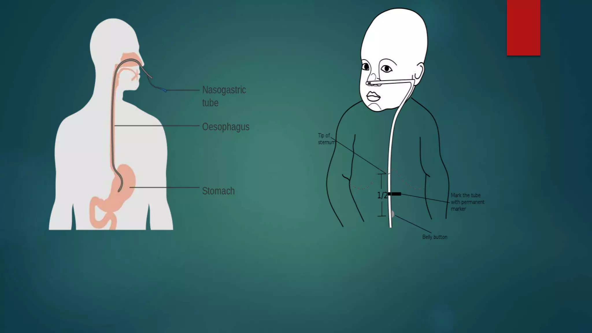 Tube feeding ( Gavage feeding ) | PPTX