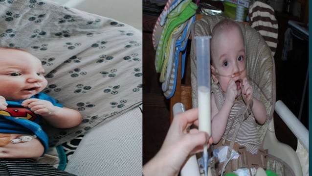 Tube feeding ( Gavage feeding ) | PPTX