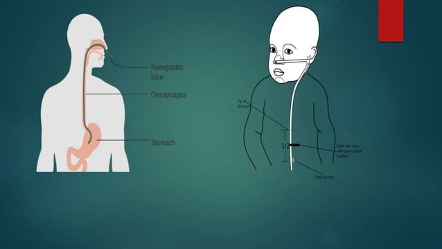 Tube feeding ( Gavage feeding ) | PPTX