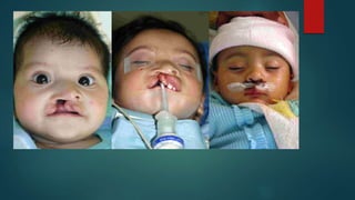 Tube feeding ( Gavage feeding ) | PPTX