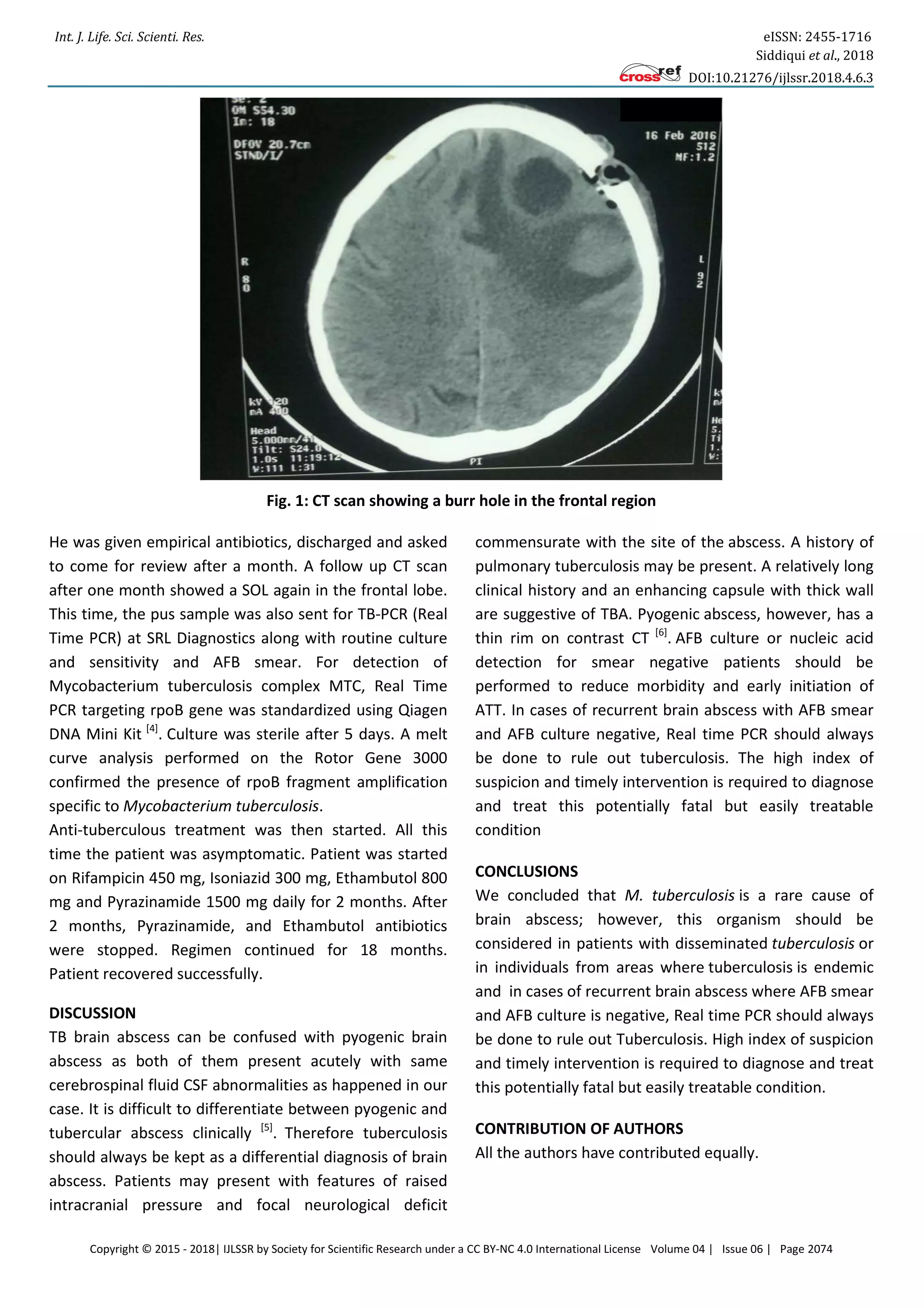 Tubercular Brain Abscess: Diagnostic Dilemma-A Case Report | PDF ...