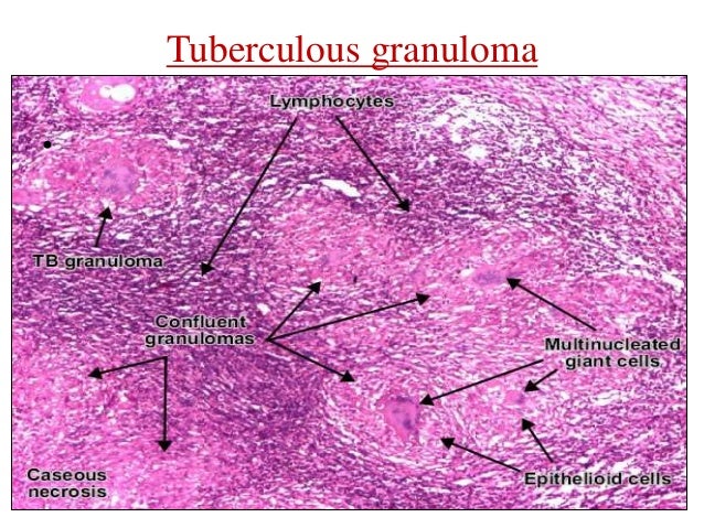 Tubercular lymphadenitis management