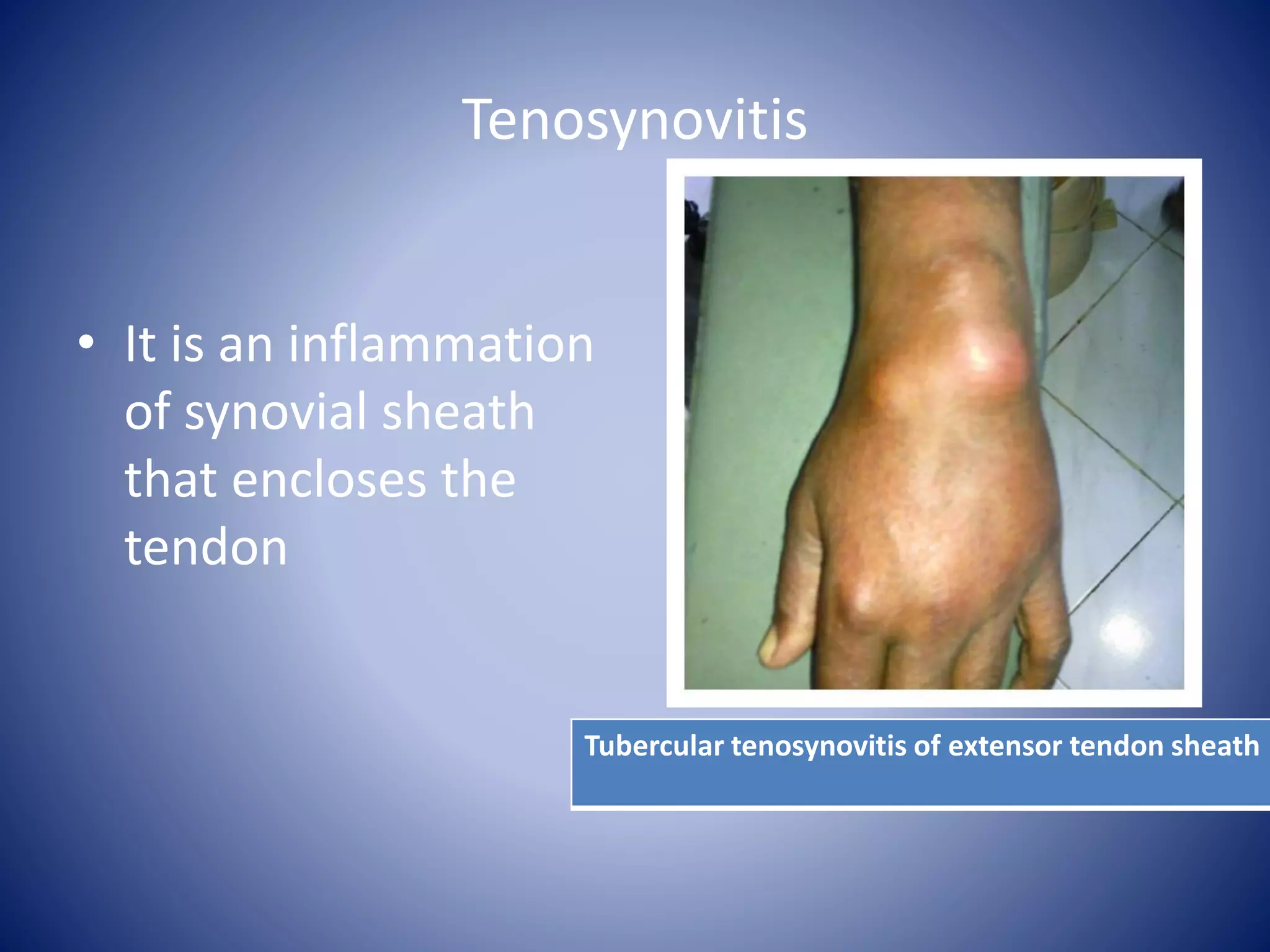 Tubercular tenosynovitis1 | PPTX