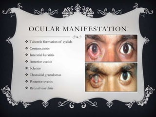 Tubercular uveitis | PPTX | Eye and Vision Conditions | Diseases and ...