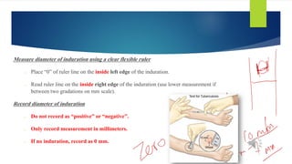 Tuberculin Skin Test (TST) Mantoux test.pdf