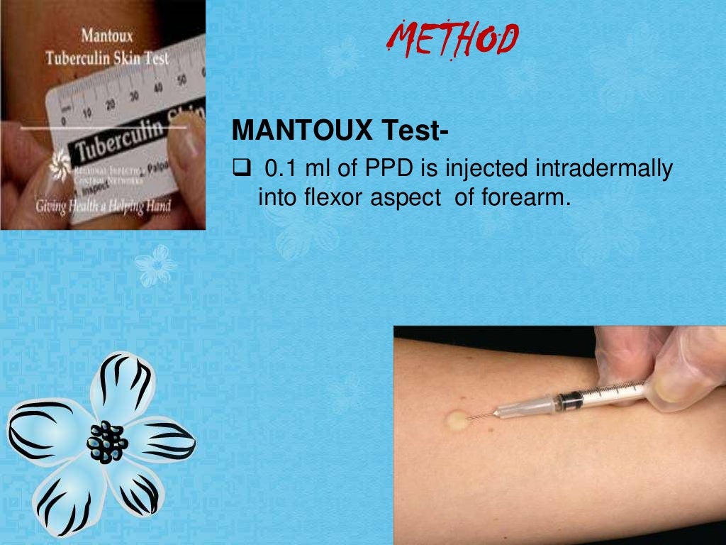 Tuberculin Test Aman Maurya tuberculin-test-aman-maurya