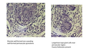 TUBERCULOID LEPROSY Histopathology PPT.pptx