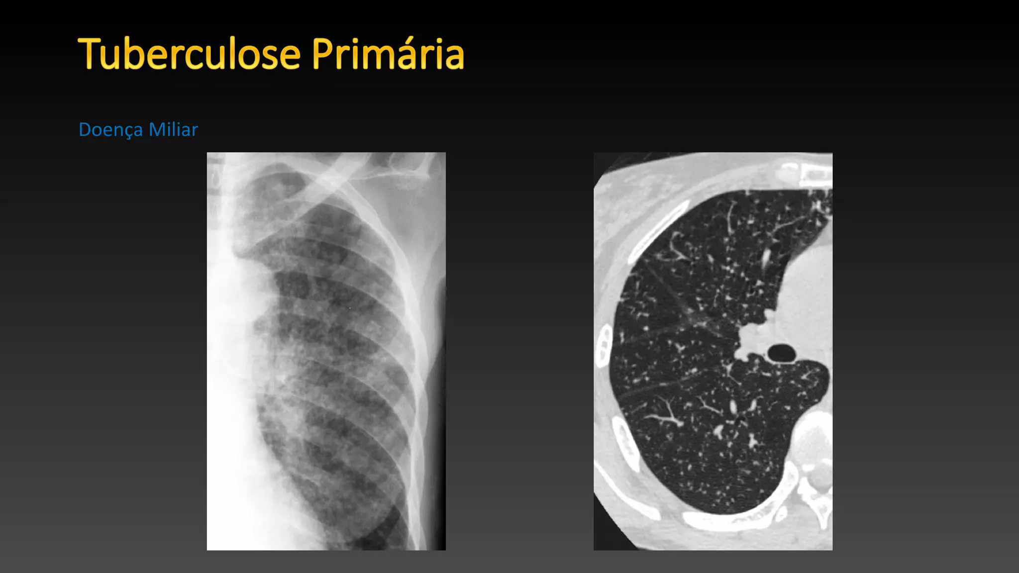 Tuberculose pulmonar e extrapulmonar- Aspectos radiológicos | PPT