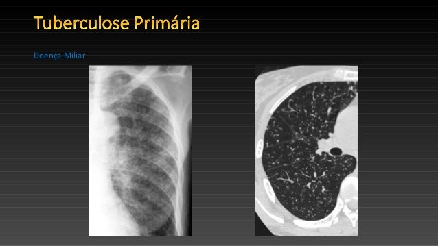 Tuberculose pulmonar e extrapulmonar- Aspectos radiológicos