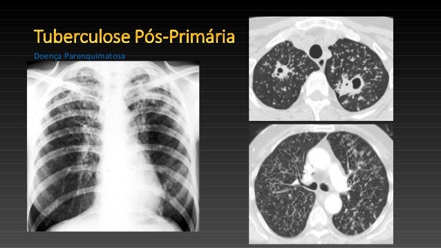 Tuberculose pulmonar e extrapulmonar- Aspectos radiológicos