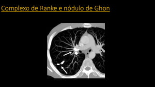 Tuberculose pleural | PPTX