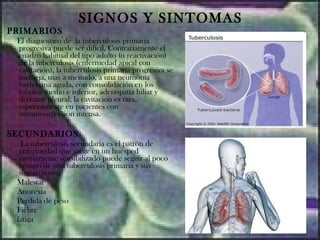 Tuberculosis | PPT