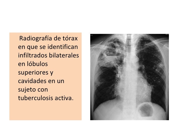 Tuberculosis