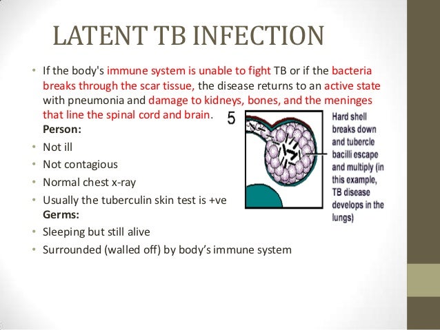 Tuberculosis tuberculosis