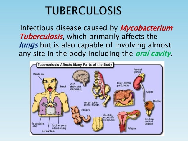 Tuberculosis and dentistry