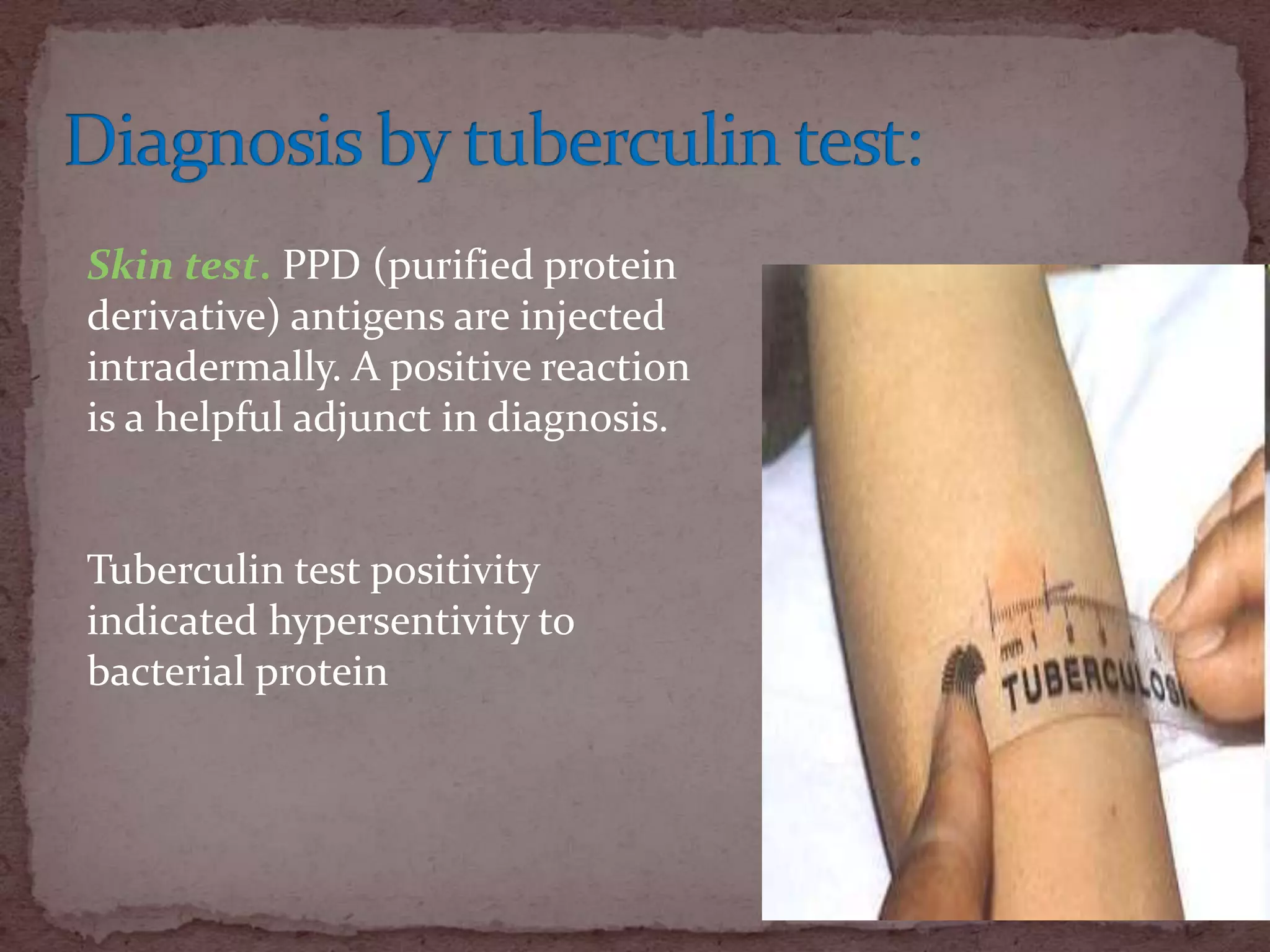 Tuberculosis | PPTX