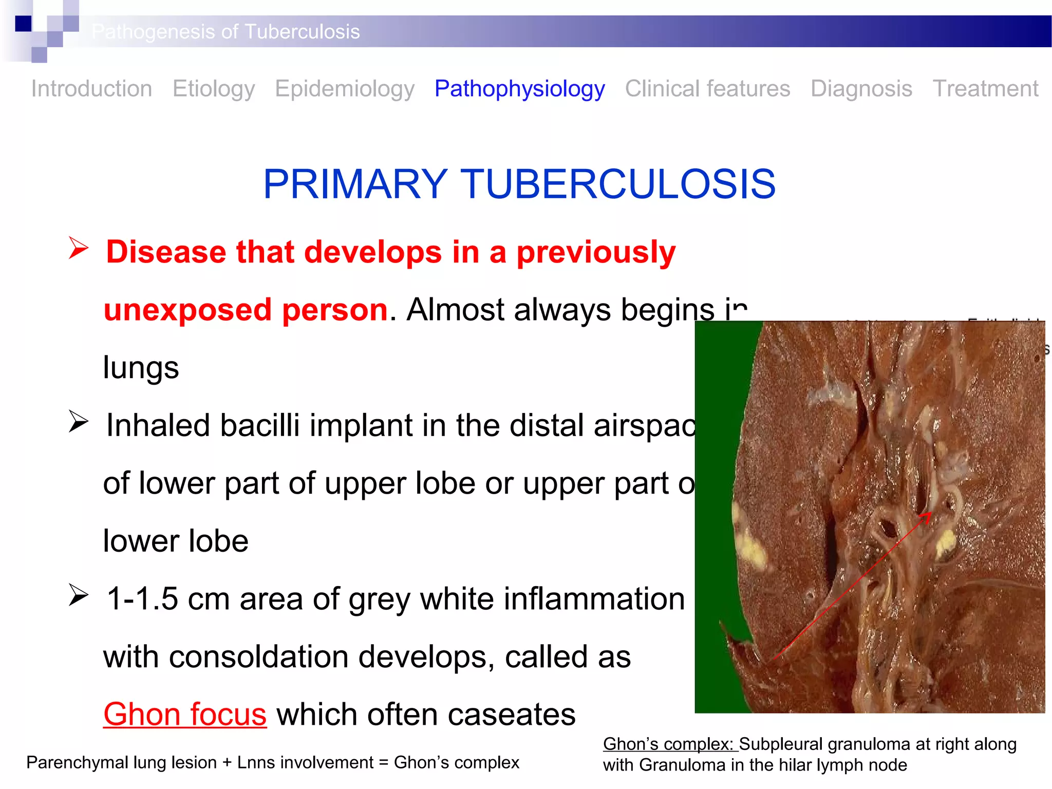 Pathogenesis of tuberculosis | PPT