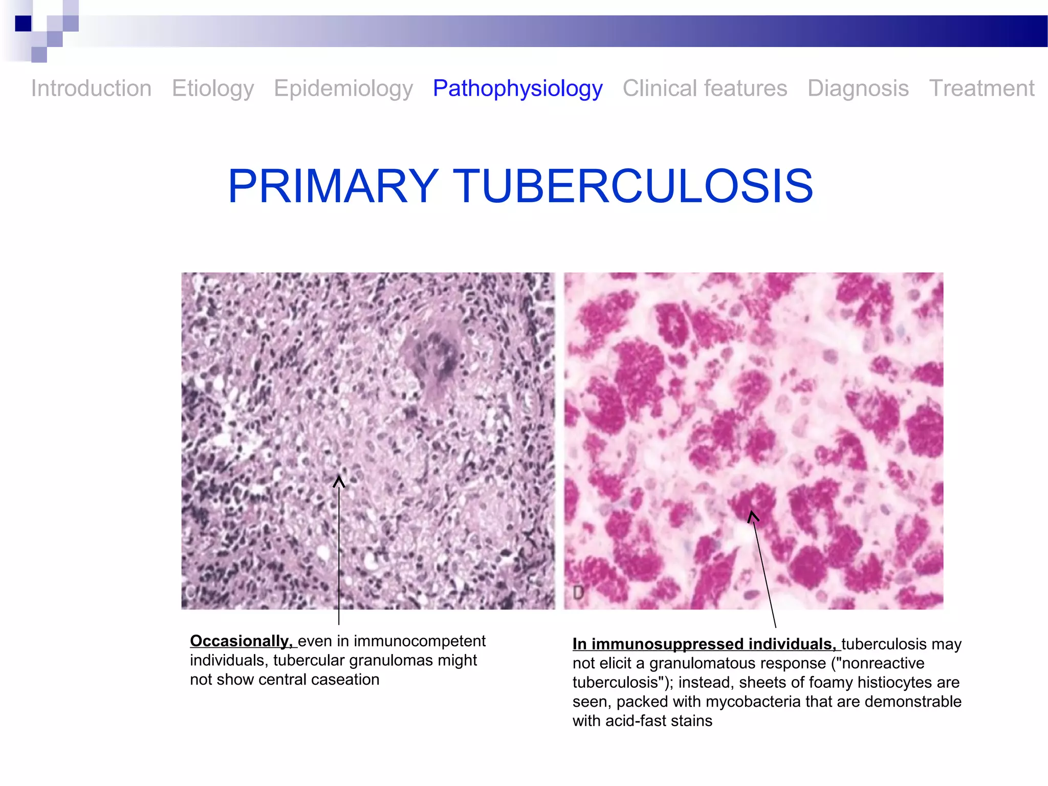Pathogenesis of tuberculosis | PPT