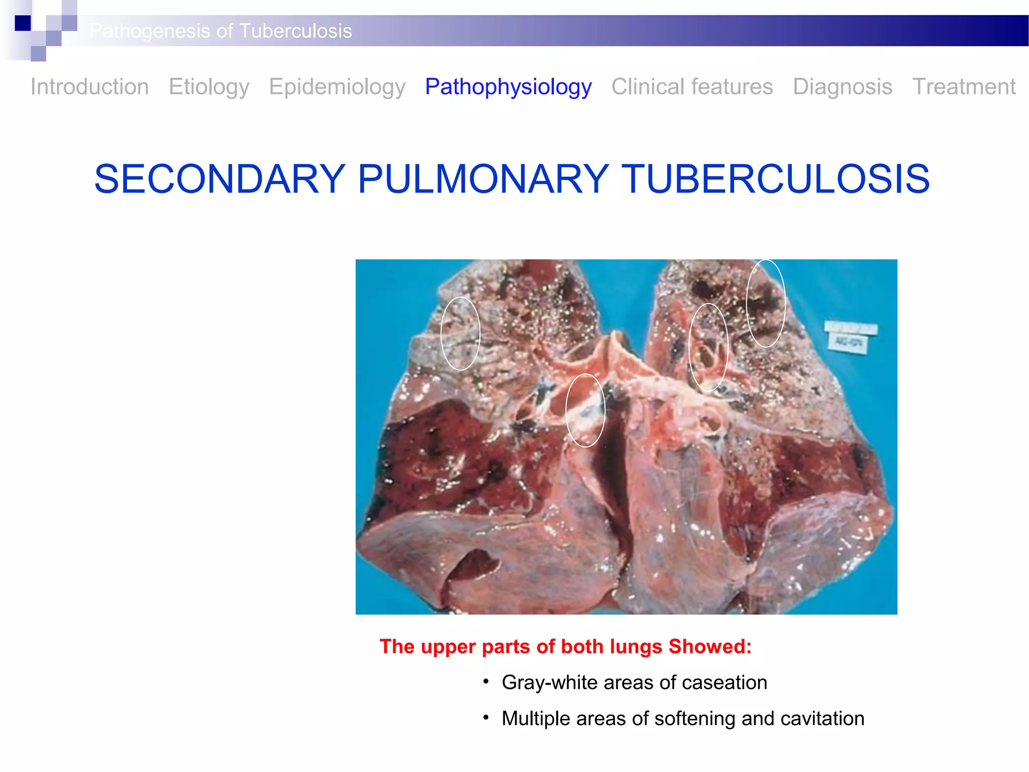 Pathogenesis of tuberculosis | PPT