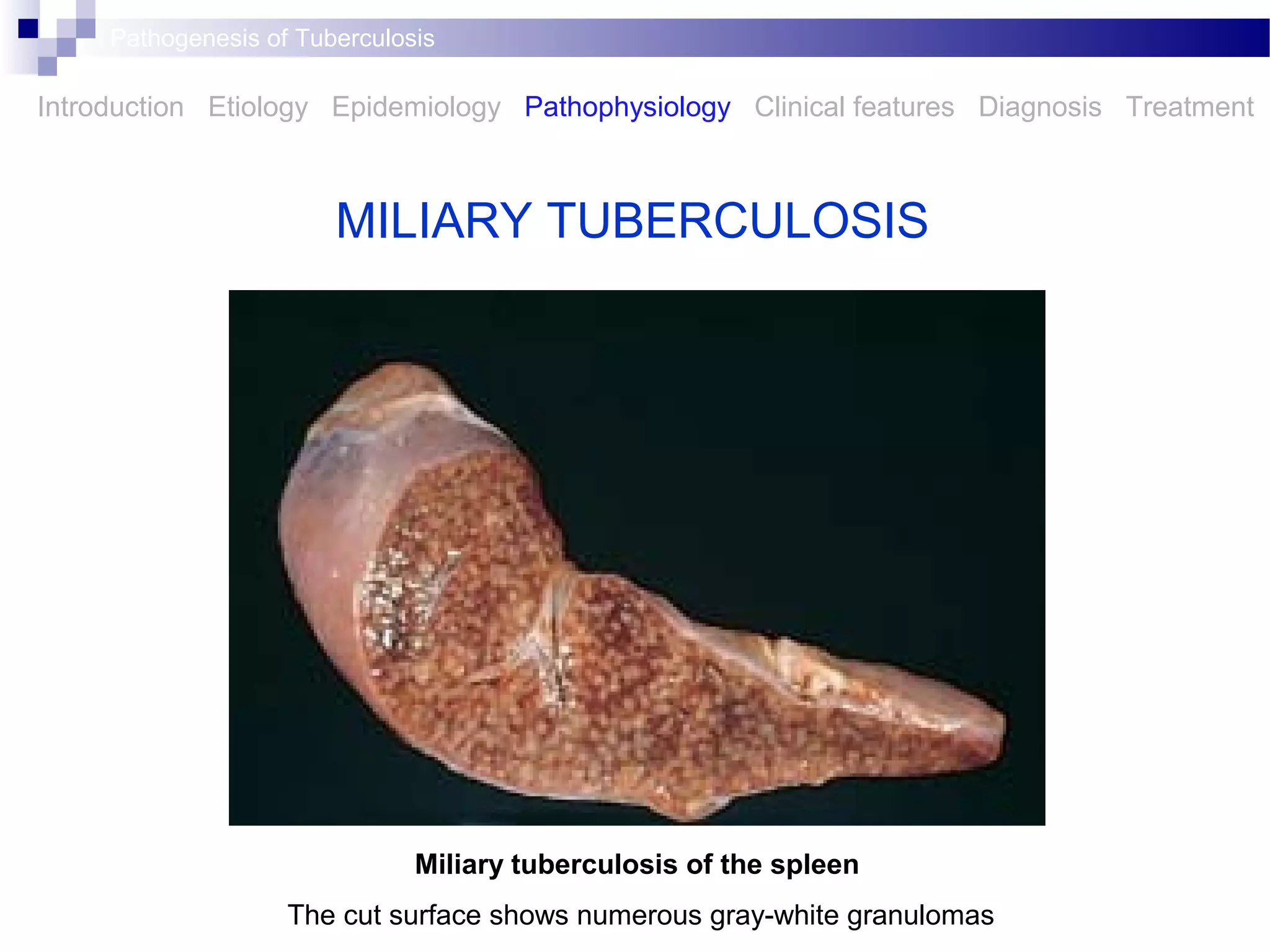 Pathogenesis of tuberculosis | PPT