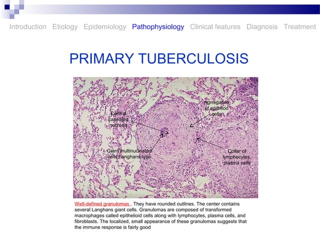 Pathogenesis of tuberculosis | PPT