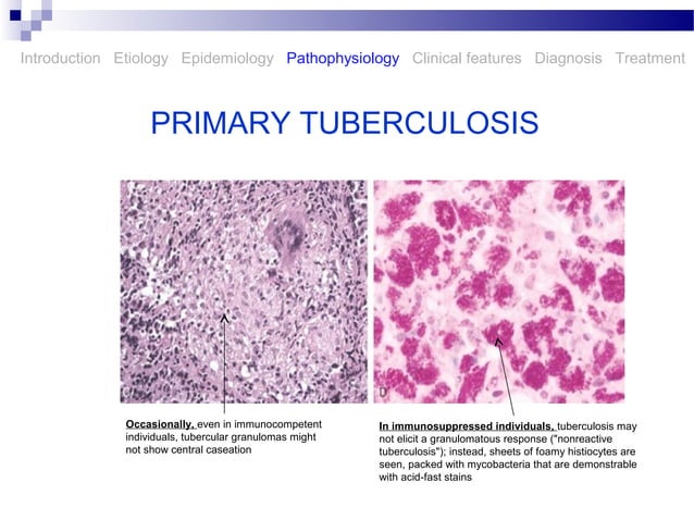 Pathogenesis of tuberculosis | PPT
