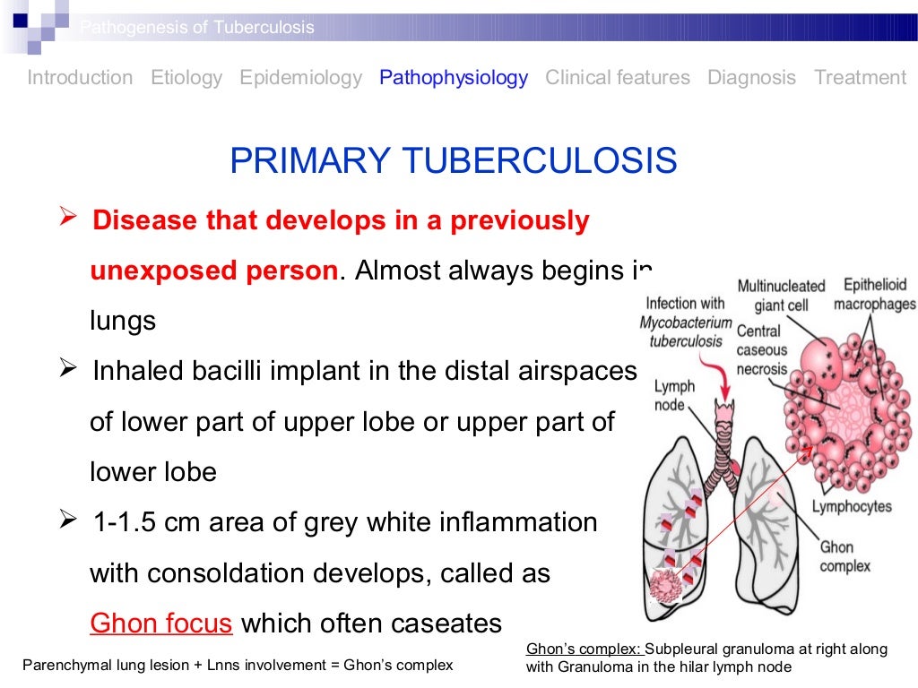 Pathogenesis of tuberculosis
