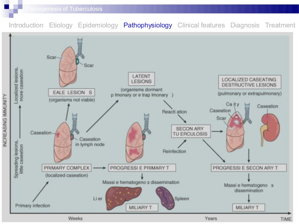 Pathogenesis of tuberculosis