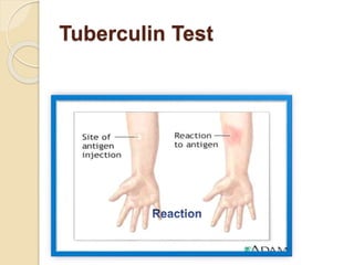 Tuberculosis