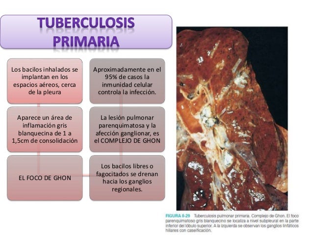 Tuberculosis