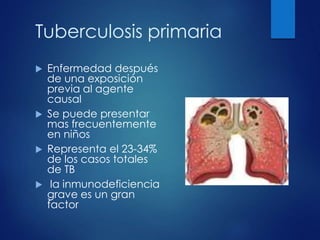 Tuberculosis | PPTX