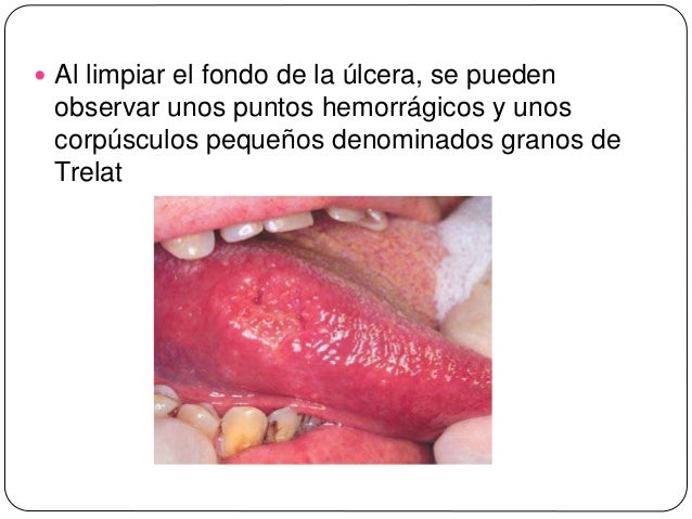 Tuberculosis