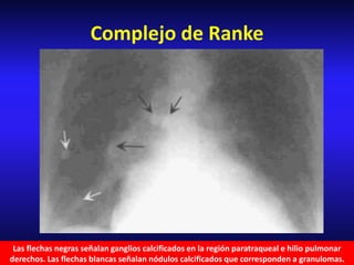 Hallazgos Radiológicos de la Tuberculosis Pulmonar | PDF