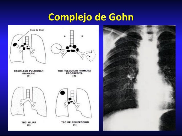 Hallazgos Radiológicos de la Tuberculosis Pulmonar