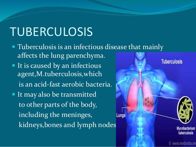 Tuberculosis