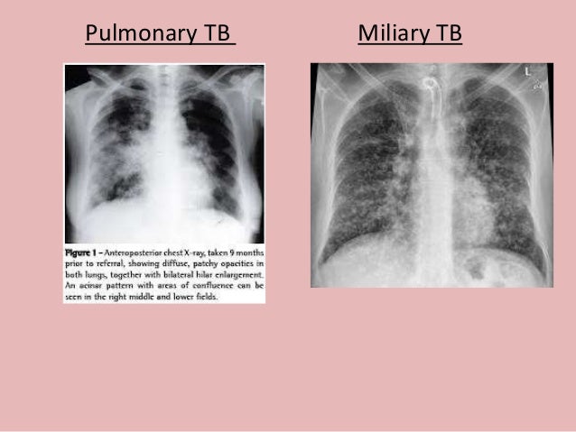 Tuberculosis