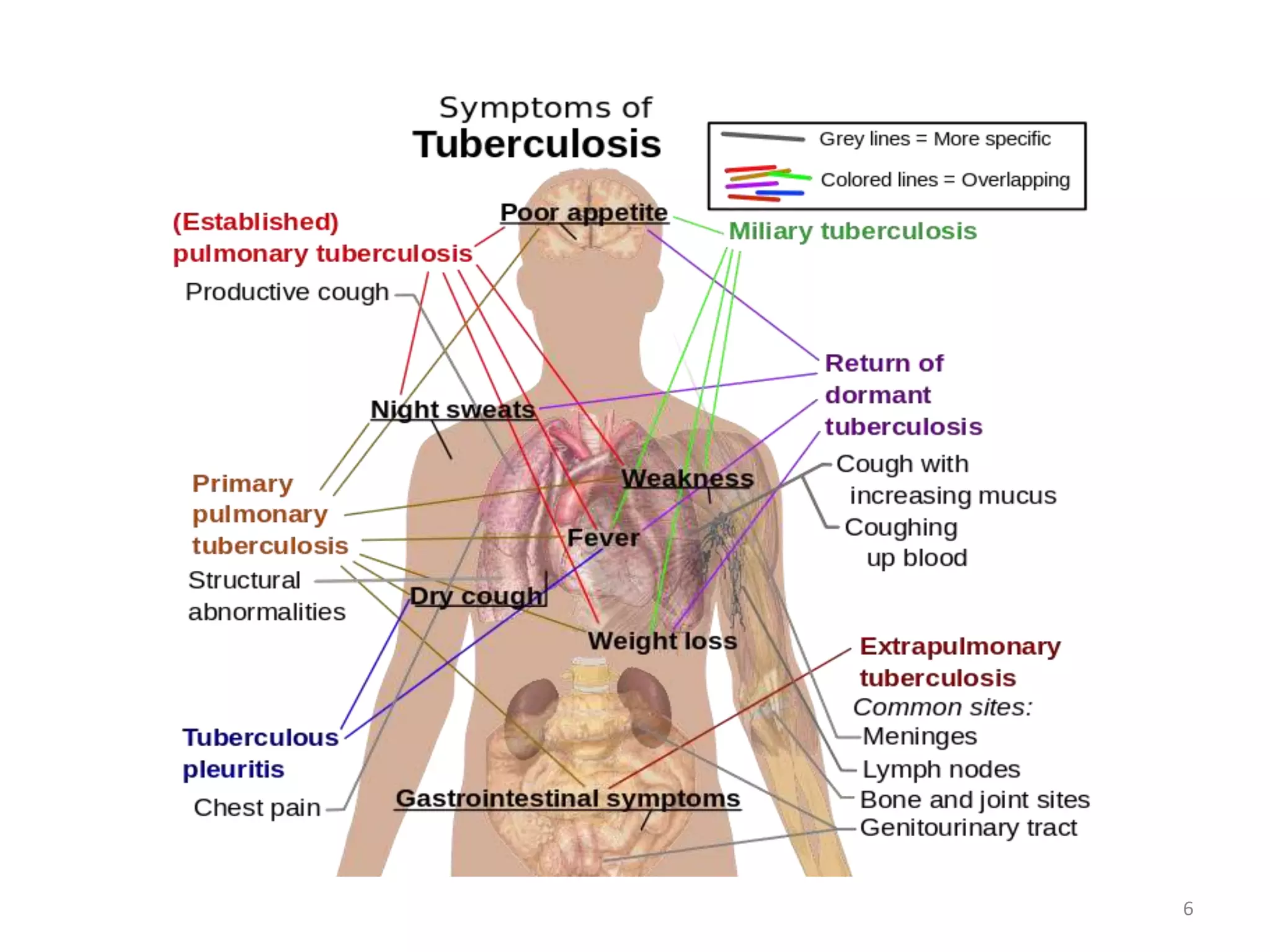 Tuberculosis - Diagnosis and Treatment | PPTX