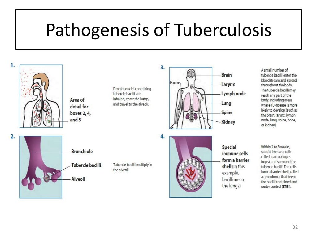 Tuberculosis - Diagnosis and Treatment