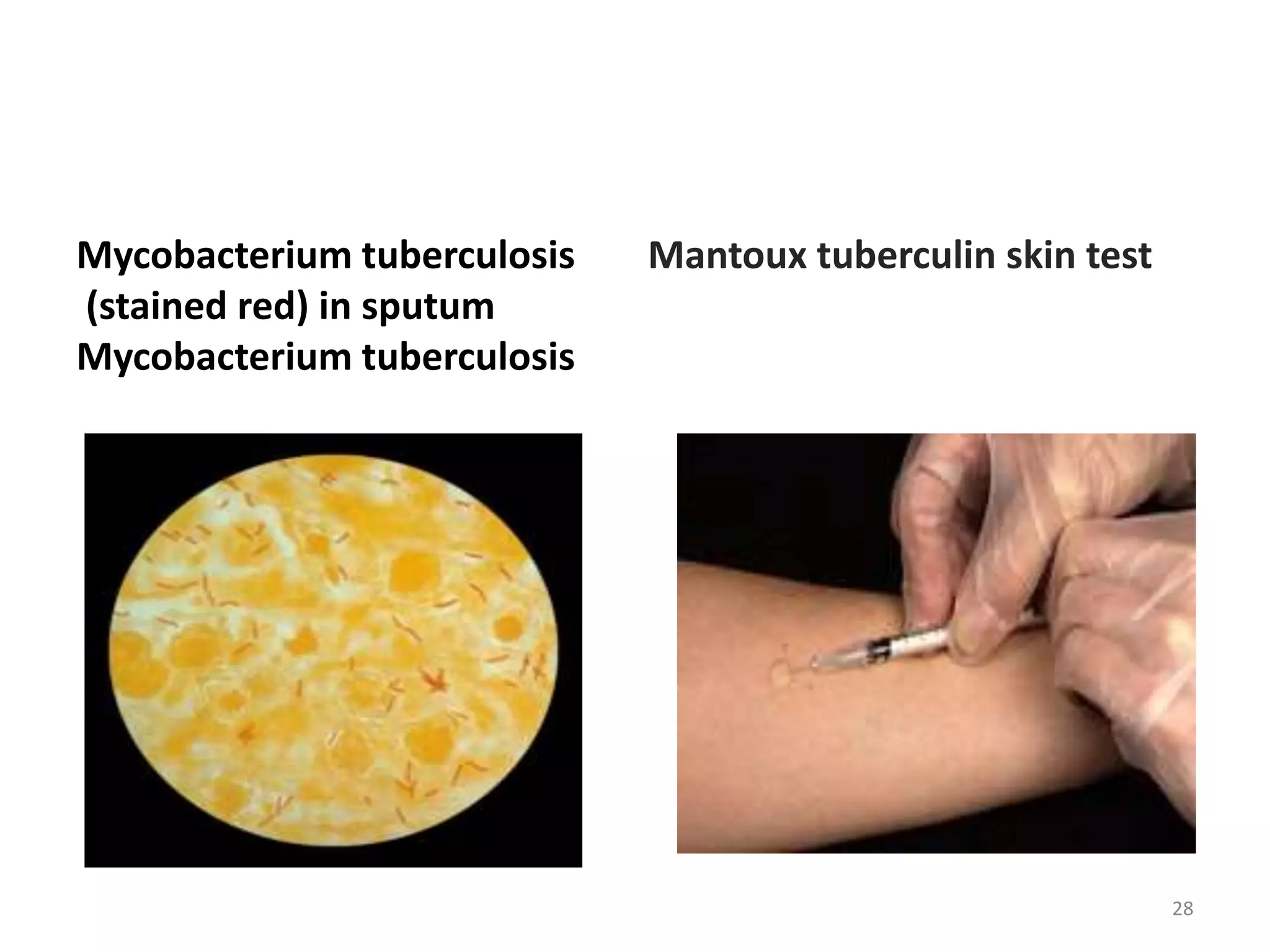 Tuberculosis | PPTX